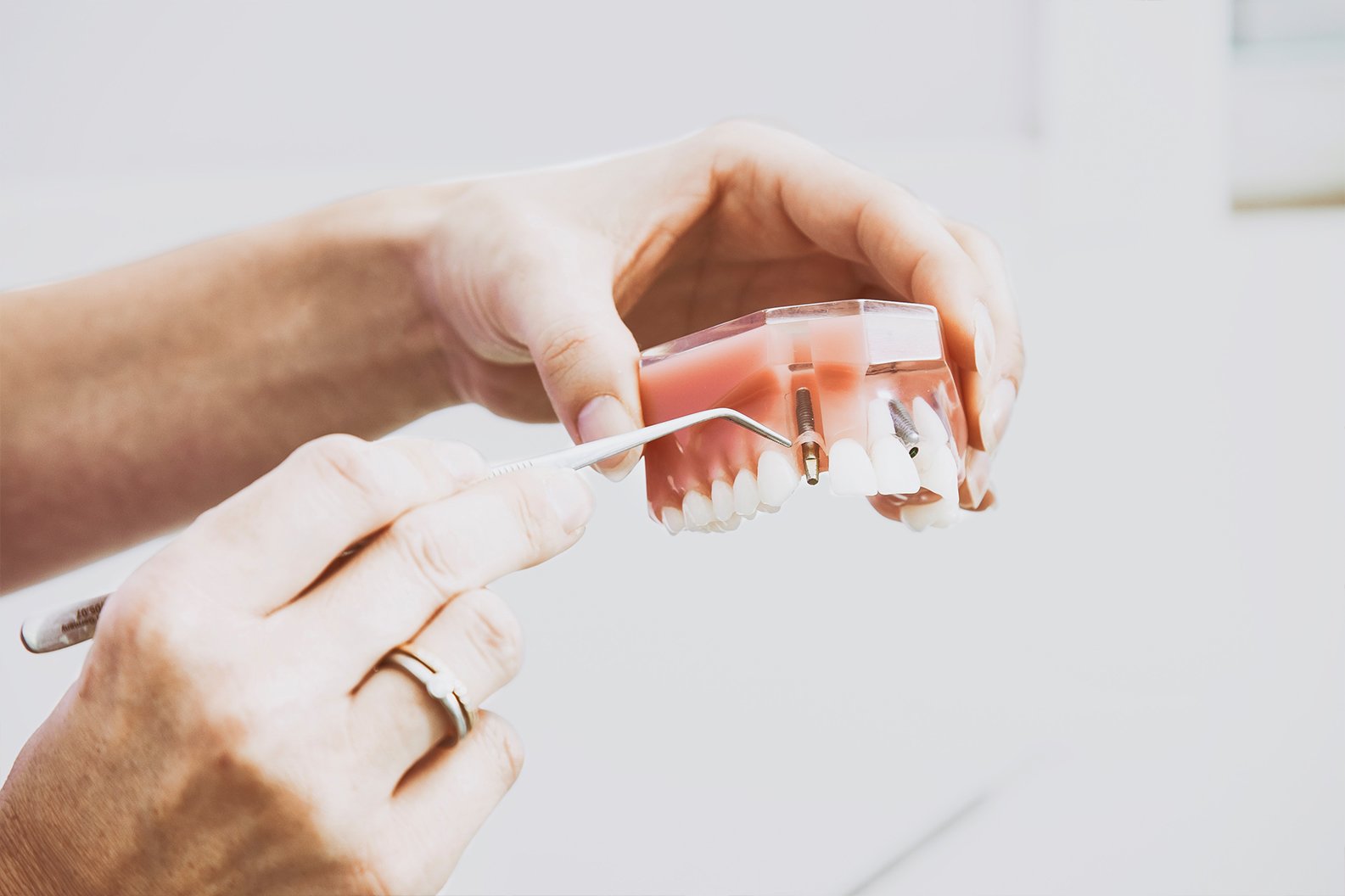 Ponts, prothèses et implants dentaires (Interventions dentaires) - ODQ